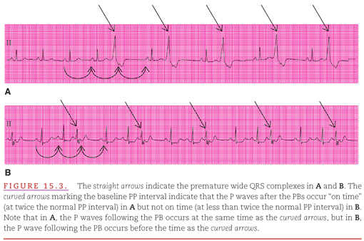 Premature Beats | Thoracic Key