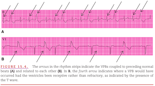 Premature Beats | Thoracic Key