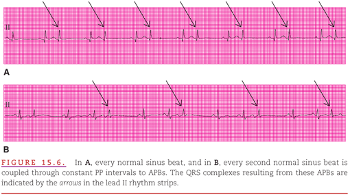 Premature Beats | Thoracic Key