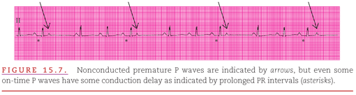 Premature Beats | Thoracic Key