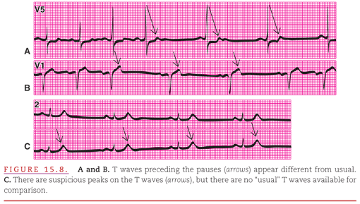 Premature Beats | Thoracic Key