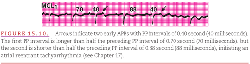 Premature Beats | Thoracic Key