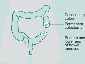 Surgery for adults | Thoracic Key