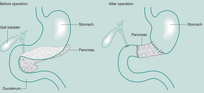 Surgery for adults | Thoracic Key