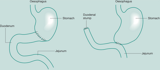 Surgery for adults | Thoracic Key