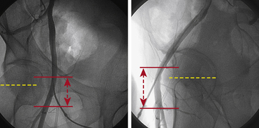 Arterial and Venous Access and Hemostasis for PCI | Thoracic Key