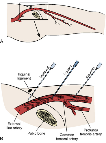 Femoral Sheath Line