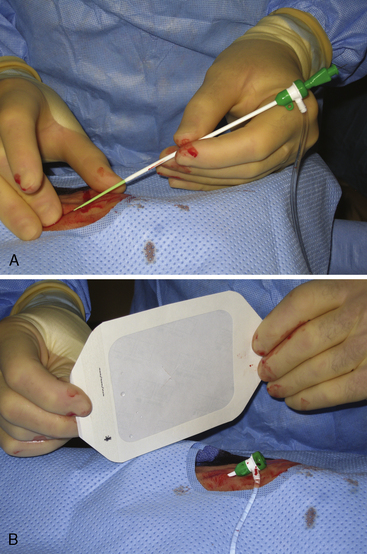 Arterial and Venous Access and Hemostasis for PCI | Thoracic Key