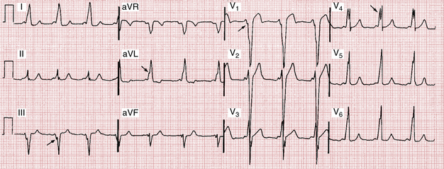 Wolff-Parkinson-White Preexcitation Patterns | Thoracic Key