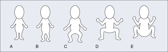 Neonatal and Pediatric Assessment | Thoracic Key
