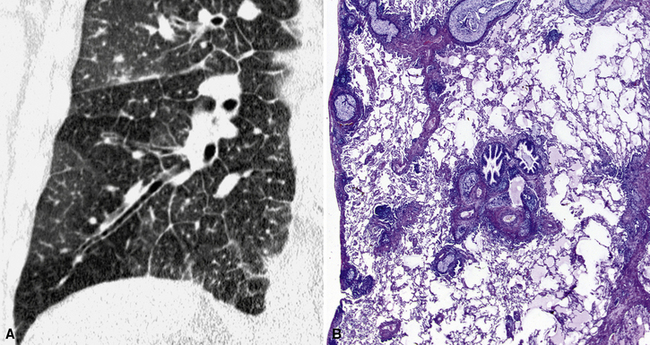 Computed Tomography of Diffuse Lung Diseases and Solitary Pulmonary ...