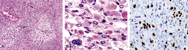 Sarcomas and Sarcomatoid Neoplasms of the Lungs and Pleural Surfaces ...