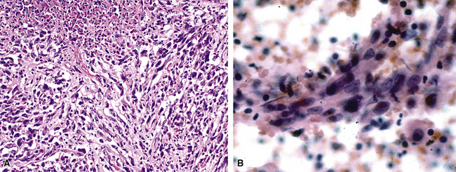 Sarcomas and Sarcomatoid Neoplasms of the Lungs and Pleural Surfaces ...