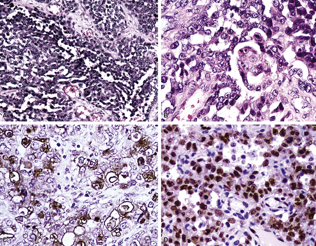 Sarcomas and Sarcomatoid Neoplasms of the Lungs and Pleural Surfaces ...