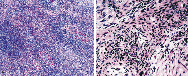 Sarcomas and Sarcomatoid Neoplasms of the Lungs and Pleural Surfaces ...