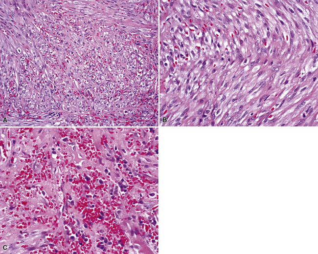 Sarcomas and Sarcomatoid Neoplasms of the Lungs and Pleural Surfaces ...
