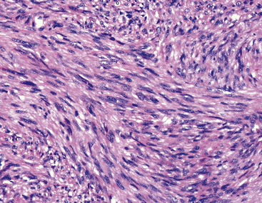 Sarcomas and Sarcomatoid Neoplasms of the Lungs and Pleural Surfaces ...