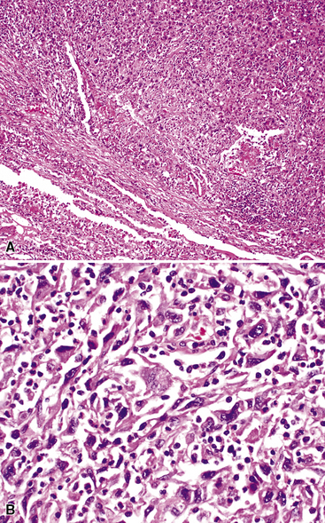 Sarcomas and Sarcomatoid Neoplasms of the Lungs and Pleural Surfaces ...