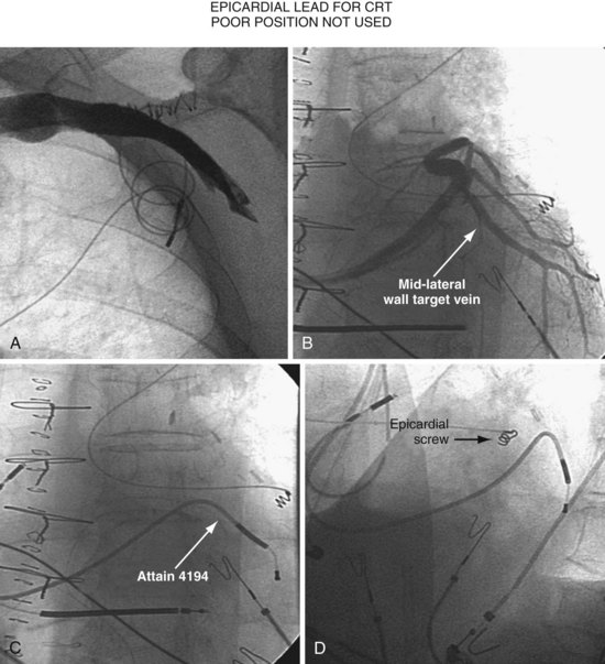 Left Ventricular Lead Implantation | Thoracic Key