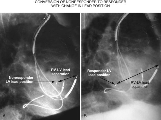 Left Ventricular Lead Implantation | Thoracic Key