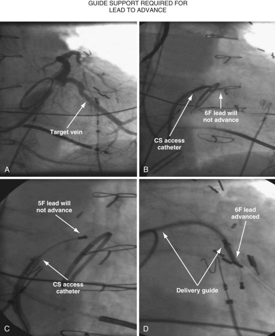 Left Ventricular Lead Implantation | Thoracic Key