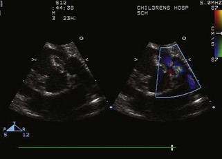 Conotruncal Lesions | Thoracic Key