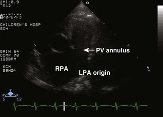 Conotruncal Lesions | Thoracic Key