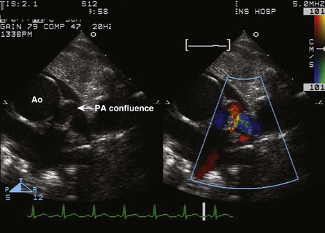 Conotruncal Lesions | Thoracic Key
