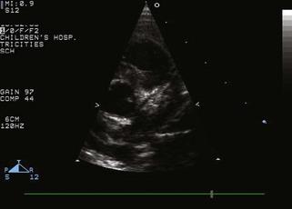 Conotruncal Lesions | Thoracic Key