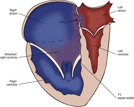 Right Heart Anomalies | Thoracic Key