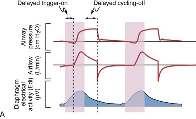 Invasive Mechanical Ventilation | Thoracic Key