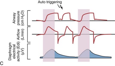 Invasive Mechanical Ventilation | Thoracic Key
