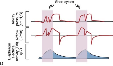 Invasive Mechanical Ventilation | Thoracic Key