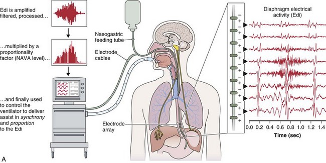 Invasive Mechanical Ventilation | Thoracic Key