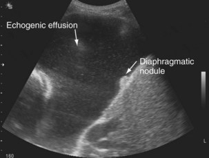 Pleural Effusion, Empyema, and Pneumothorax | Thoracic Key