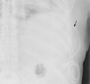 Pleural Effusion, Empyema, and Pneumothorax | Thoracic Key