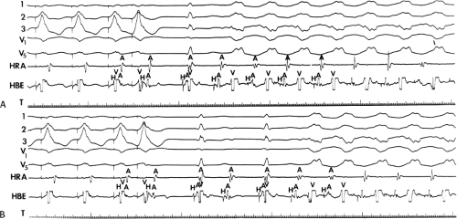 Preexcitation Syndromes | Thoracic Key
