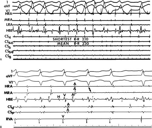 Preexcitation Syndromes | Thoracic Key