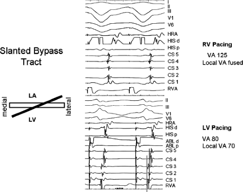 Preexcitation Syndromes | Thoracic Key