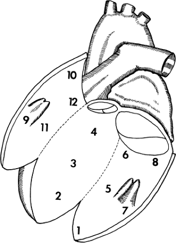 Recurrent Ventricular Tachycardia | Thoracic Key