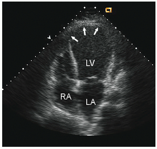 Echocardiography and Coronary Artery Disease | Thoracic Key