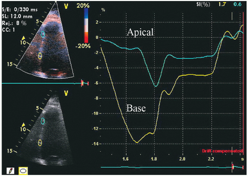 Echocardiography and Coronary Artery Disease | Thoracic Key