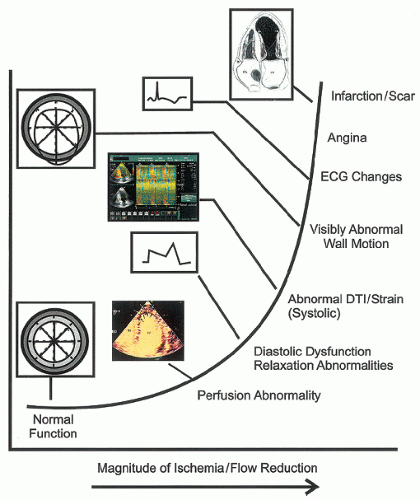 Echocardiography and Coronary Artery Disease | Thoracic Key