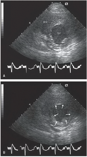 Stress Echocardiography | Thoracic Key