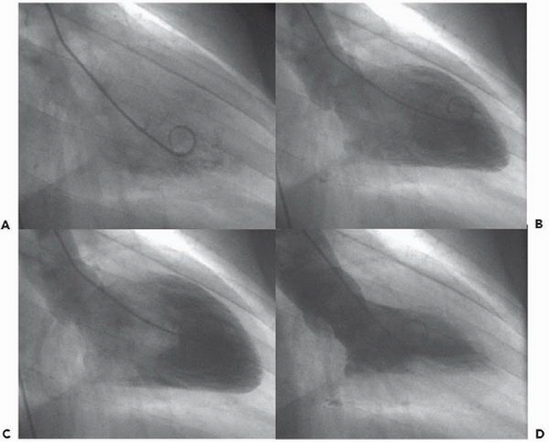 Cardiac Ventriculography | Thoracic Key