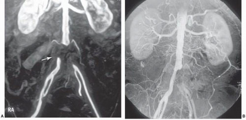 Angiography of the Aorta and Peripheral Arteries | Thoracic Key
