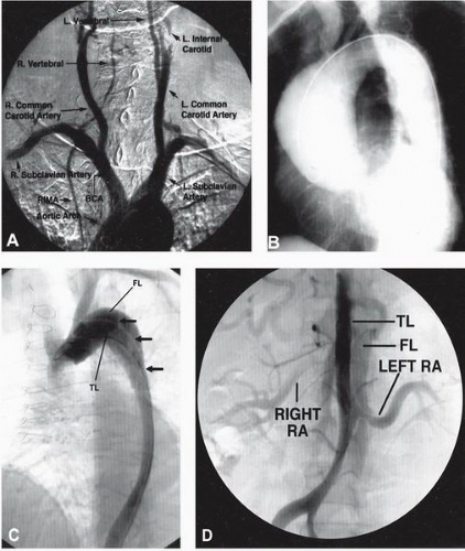 Angiography of the Aorta and Peripheral Arteries | Thoracic Key