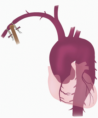 Blood Pumps, Circuitry, and Cannulation Techniques in Cardiopulmonary ...
