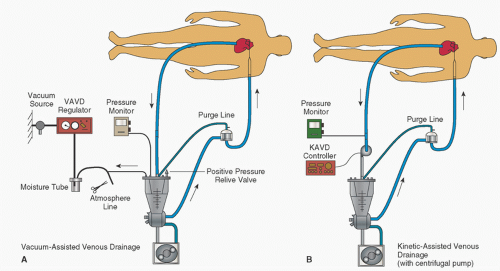 Blood Pumps, Circuitry, and Cannulation Techniques in Cardiopulmonary ...