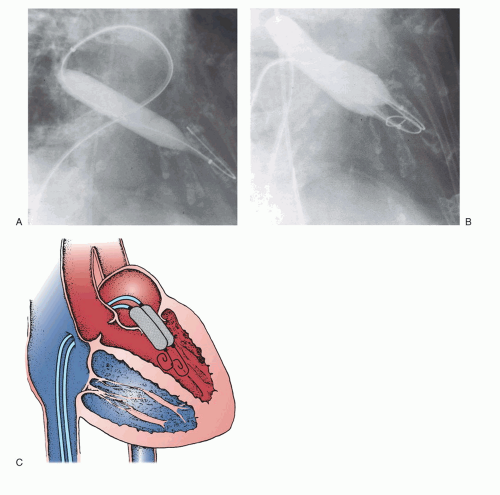 Percutaneous Therapies for Valvular Heart Disease | Thoracic Key